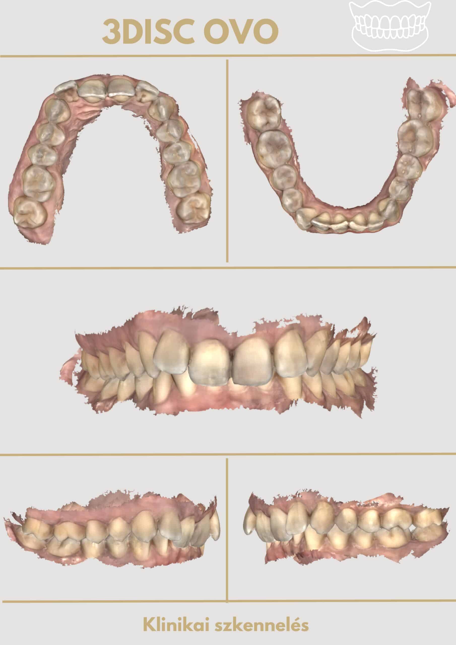 3DISC – Intraoral scanners