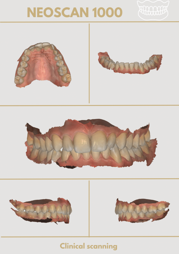 Neoss – Intraoral scanners