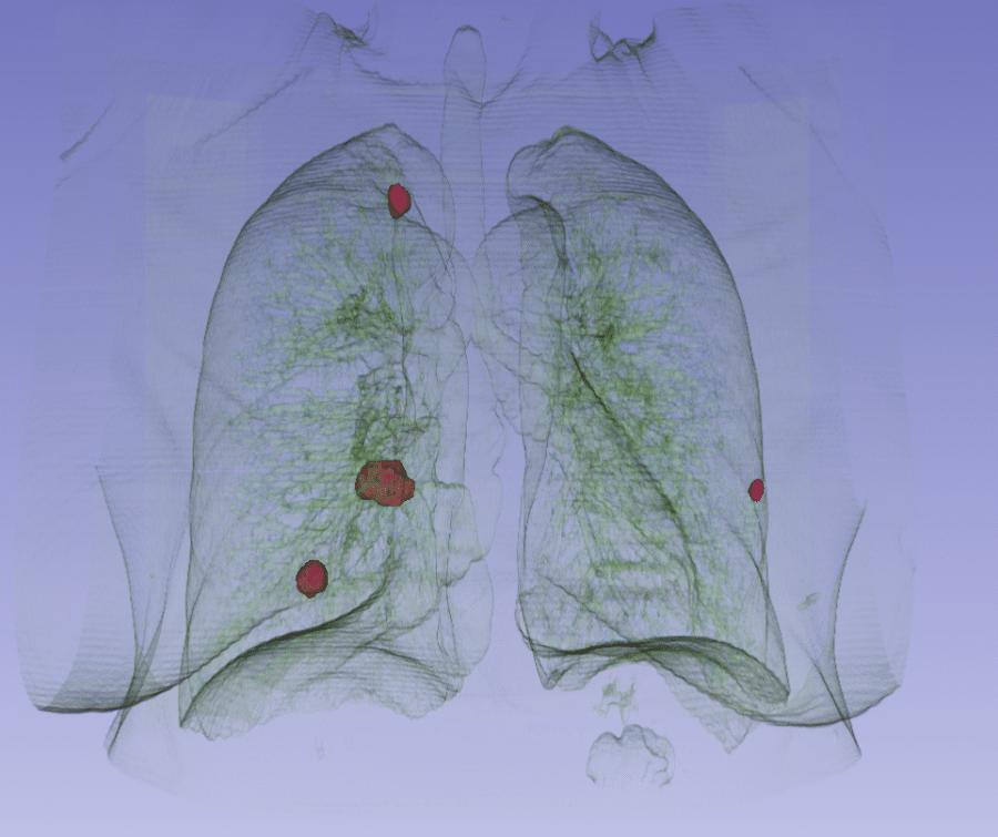 Artificial intelligence helps to screen lung cancer more effectively ...