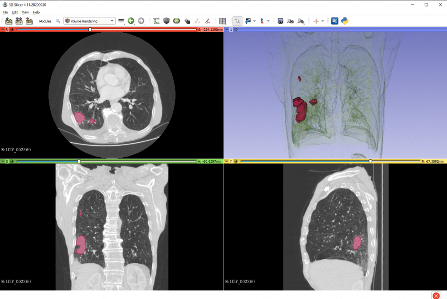 Artificial intelligence helps to screen lung cancer more effectively ...