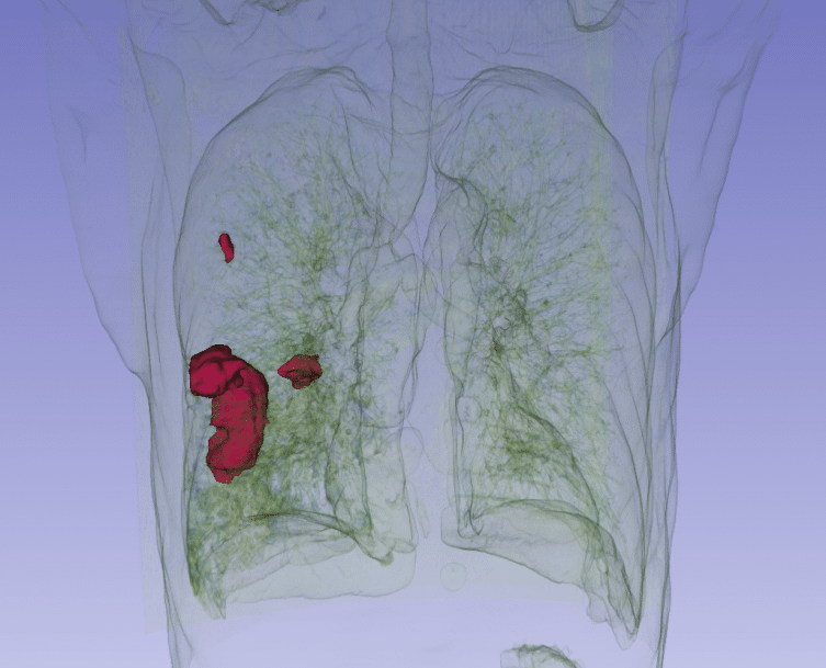 Artificial intelligence helps to screen lung cancer more effectively ...