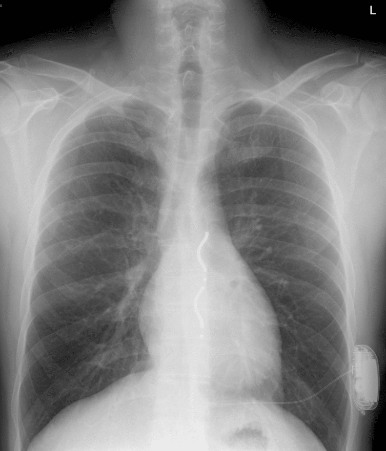 A newly developed device prevents sudden cardiac death at Semmelweis ...