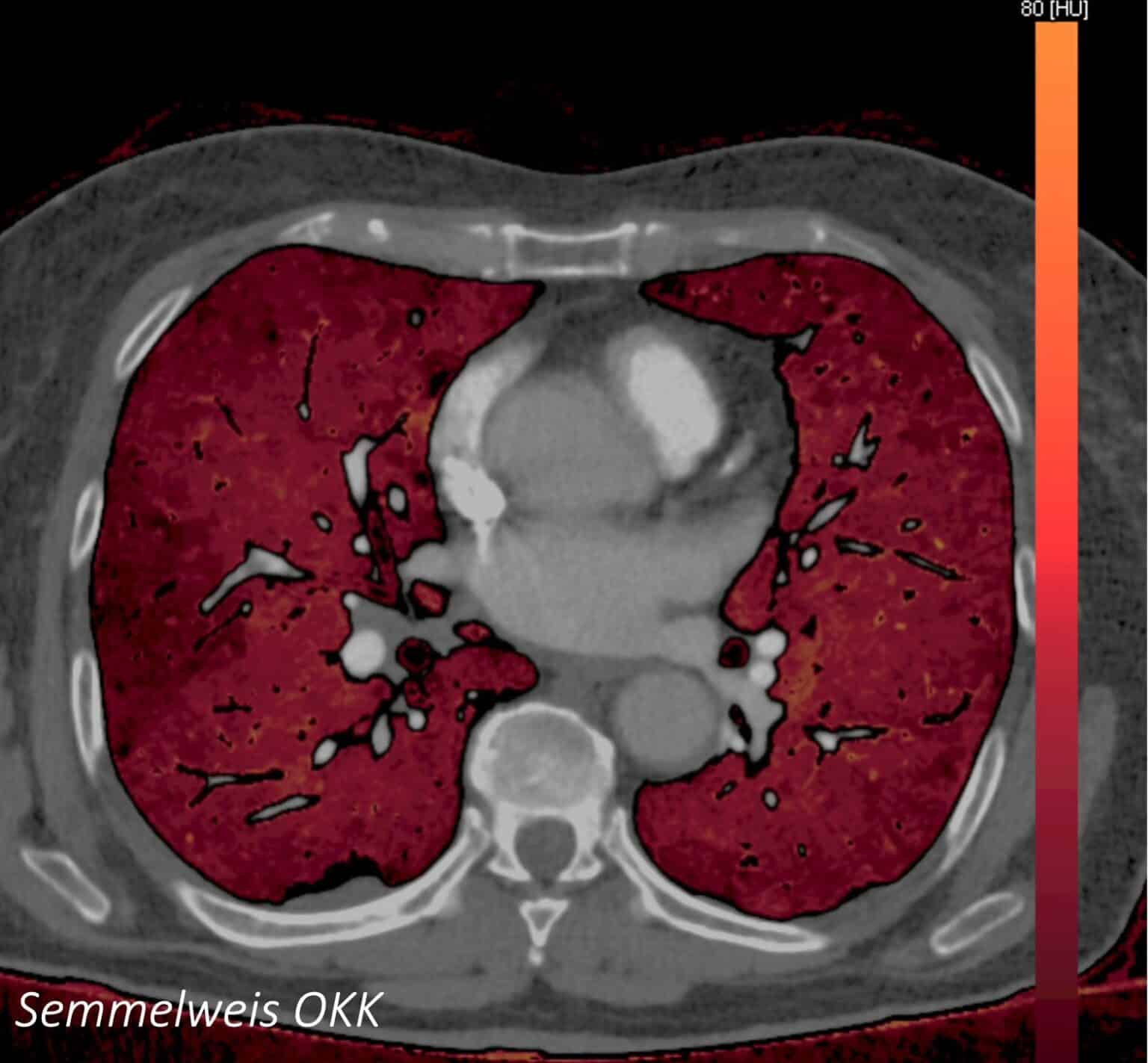 The world’s most advanced CT scanner was inaugurated at Semmelweis ...