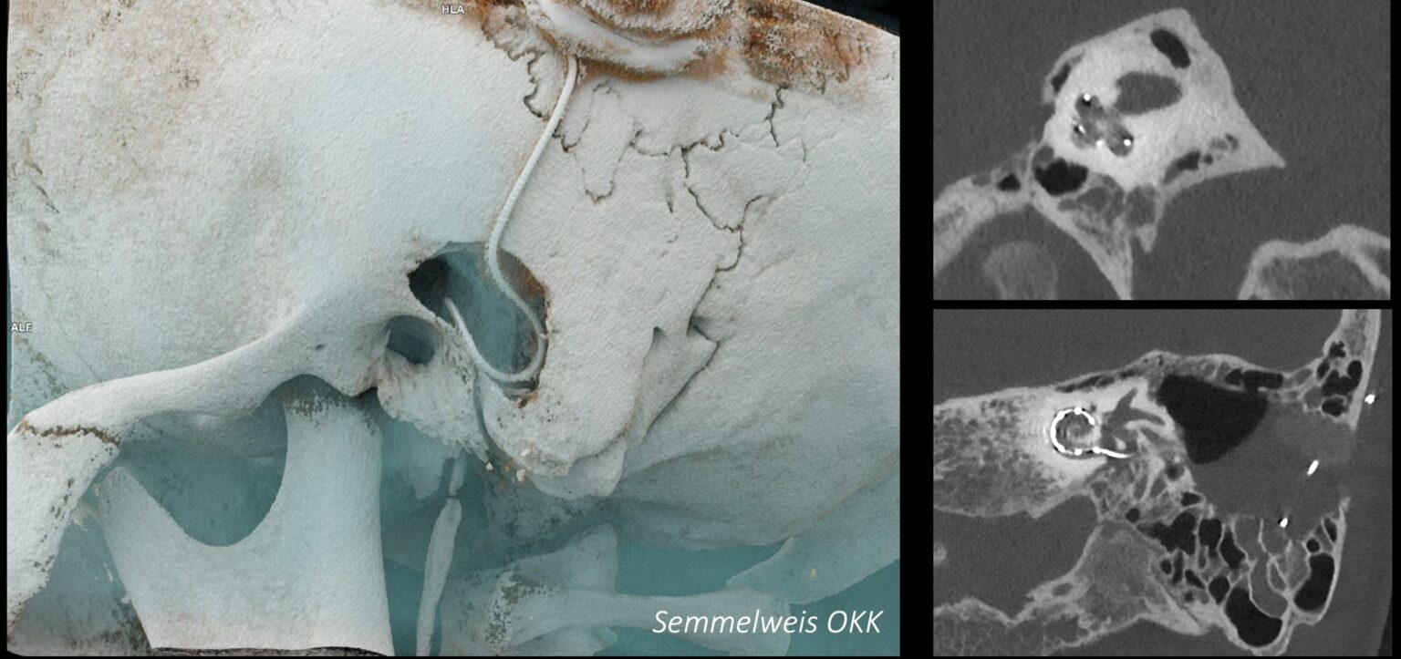 The world’s most advanced CT scanner was inaugurated at Semmelweis ...
